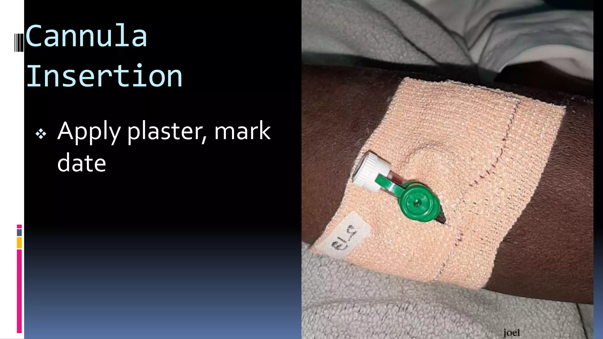 Cannulation and complications | PPTX