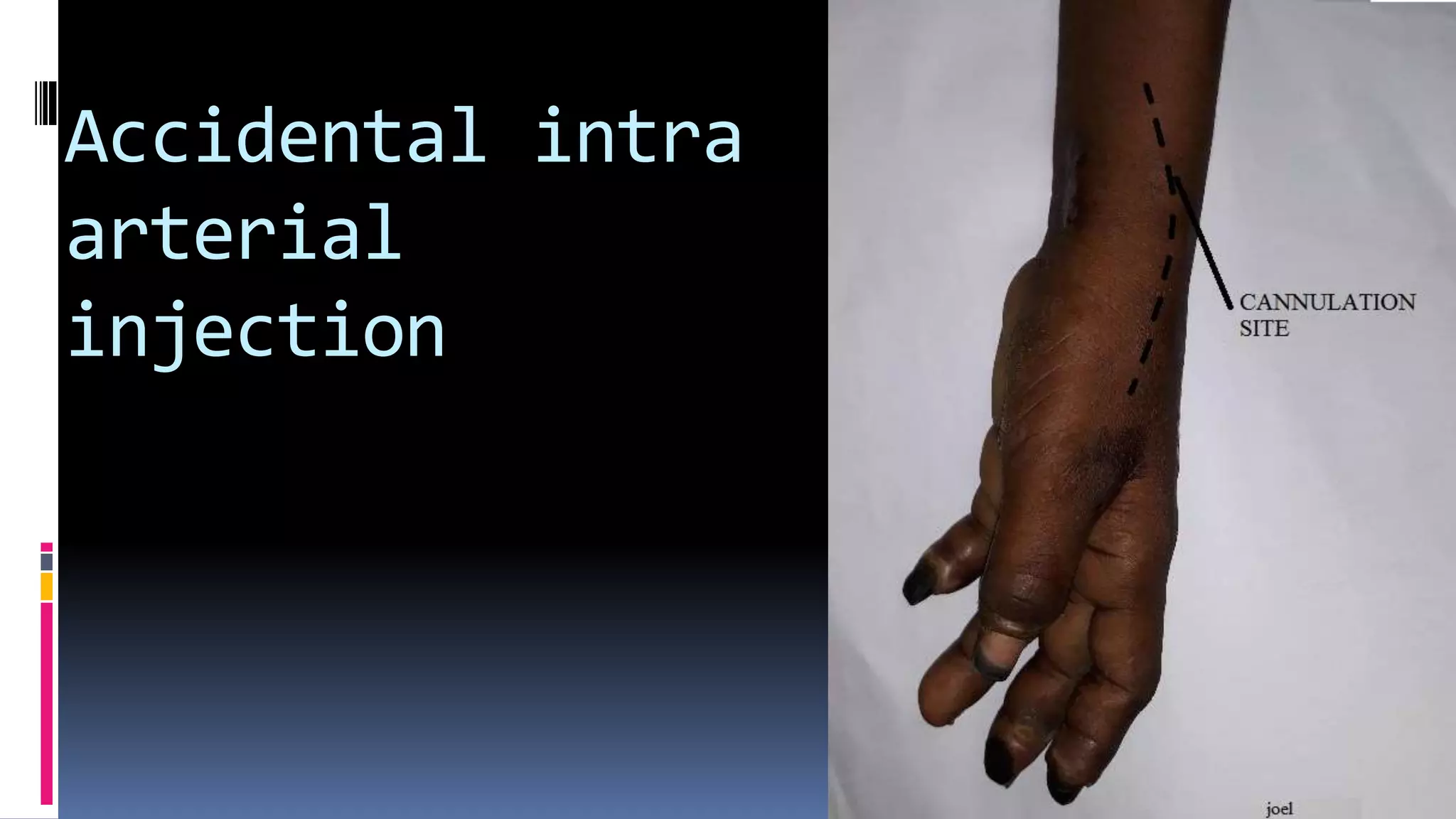 Cannulation and complications | PPTX