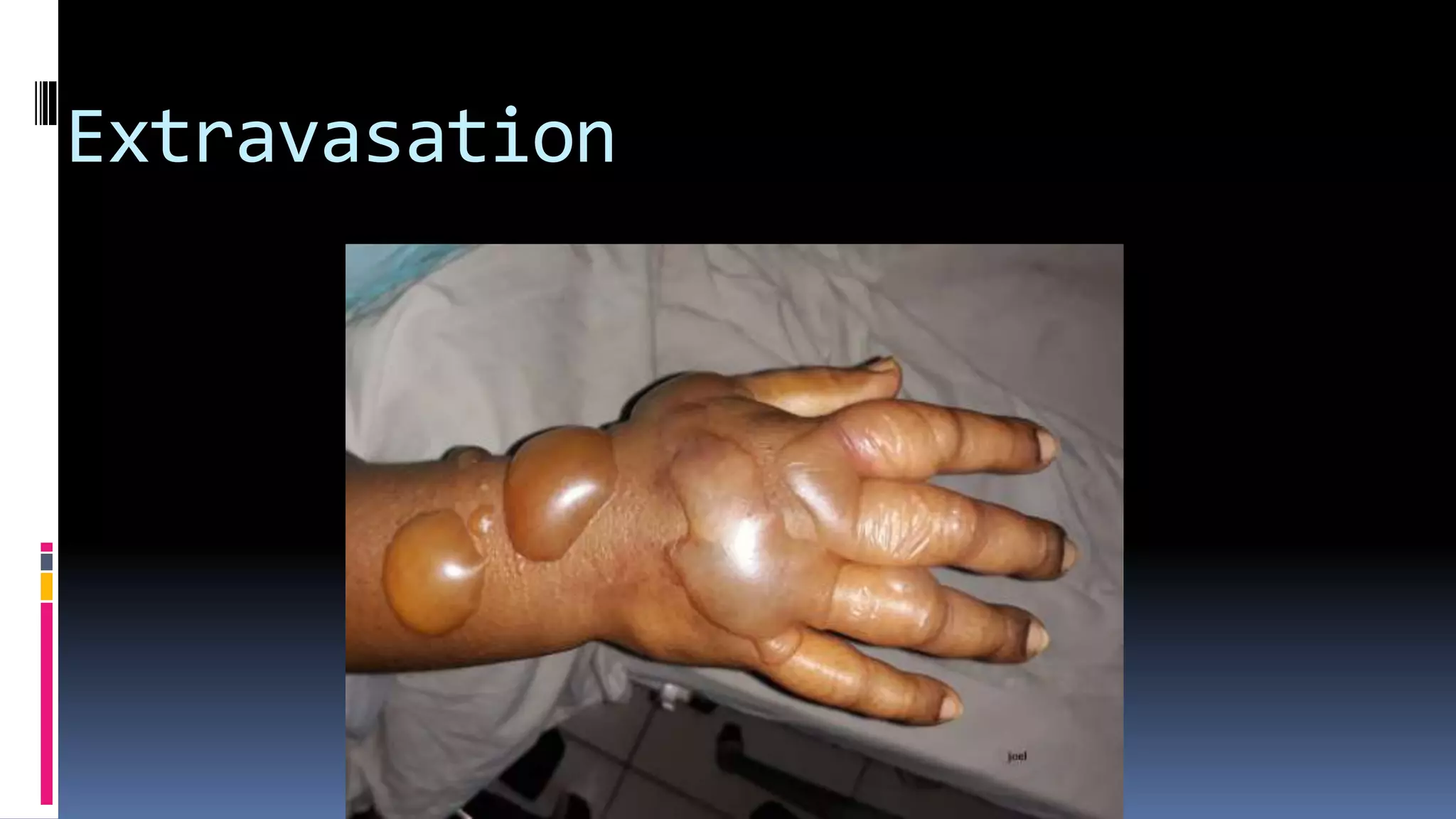 Cannulation and complications | PPTX