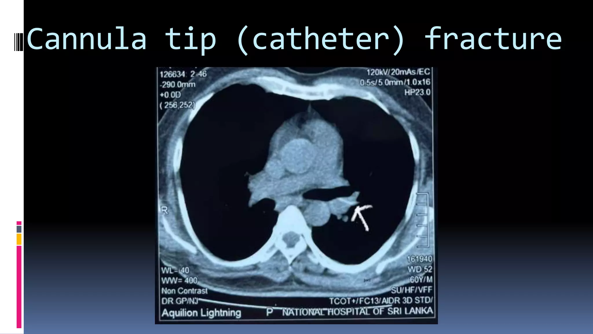 Cannulation and complications | PPTX