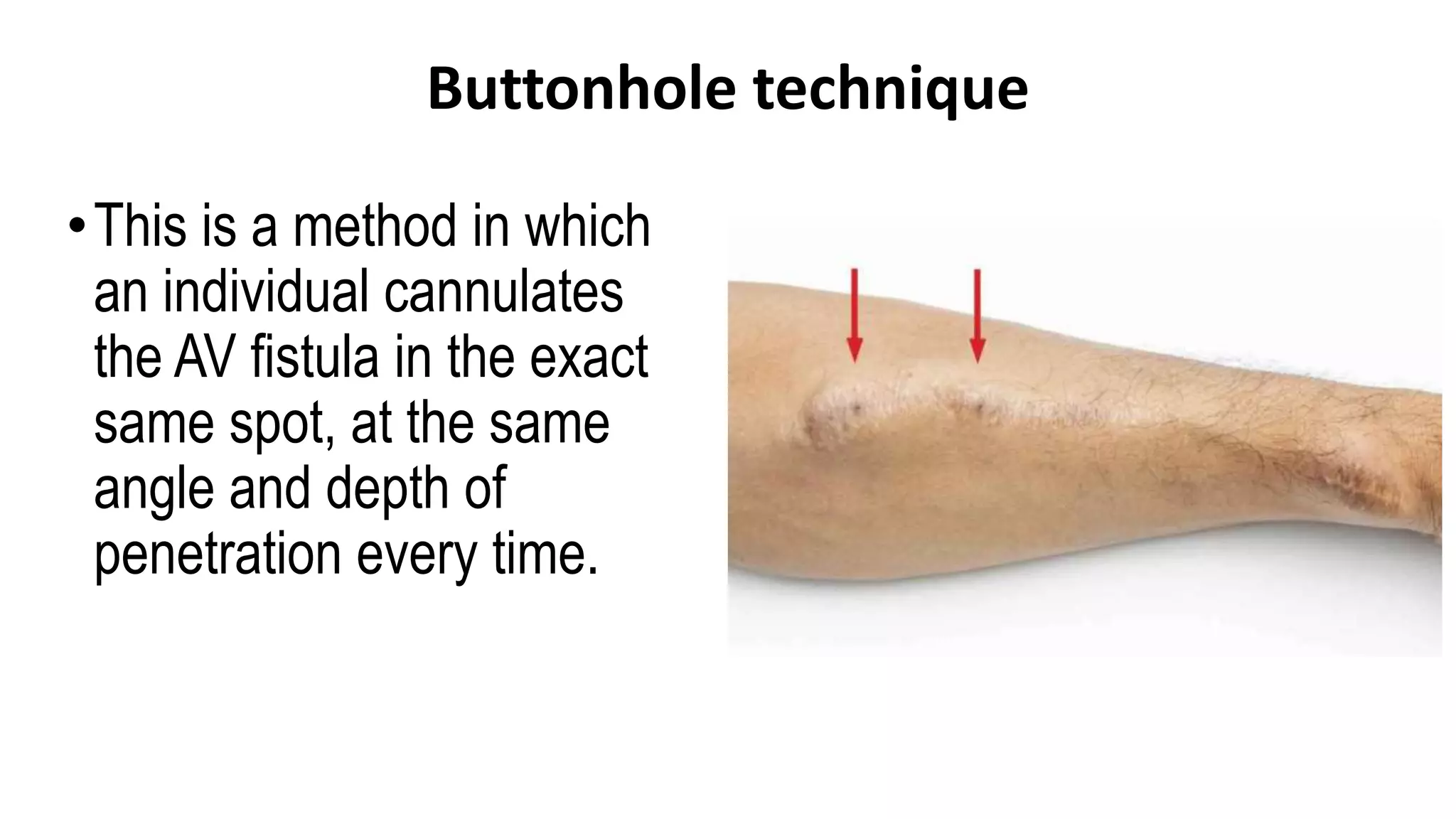 CANNULATION PROCEDURE.pptx
