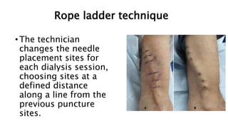 CANNULATION PROCEDURE.pptx