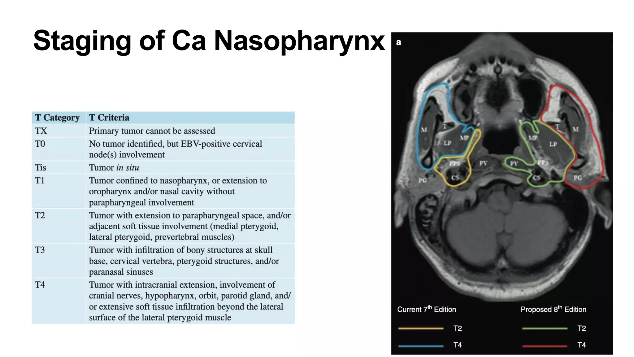 Ca Nasopharynx contouring.pptx