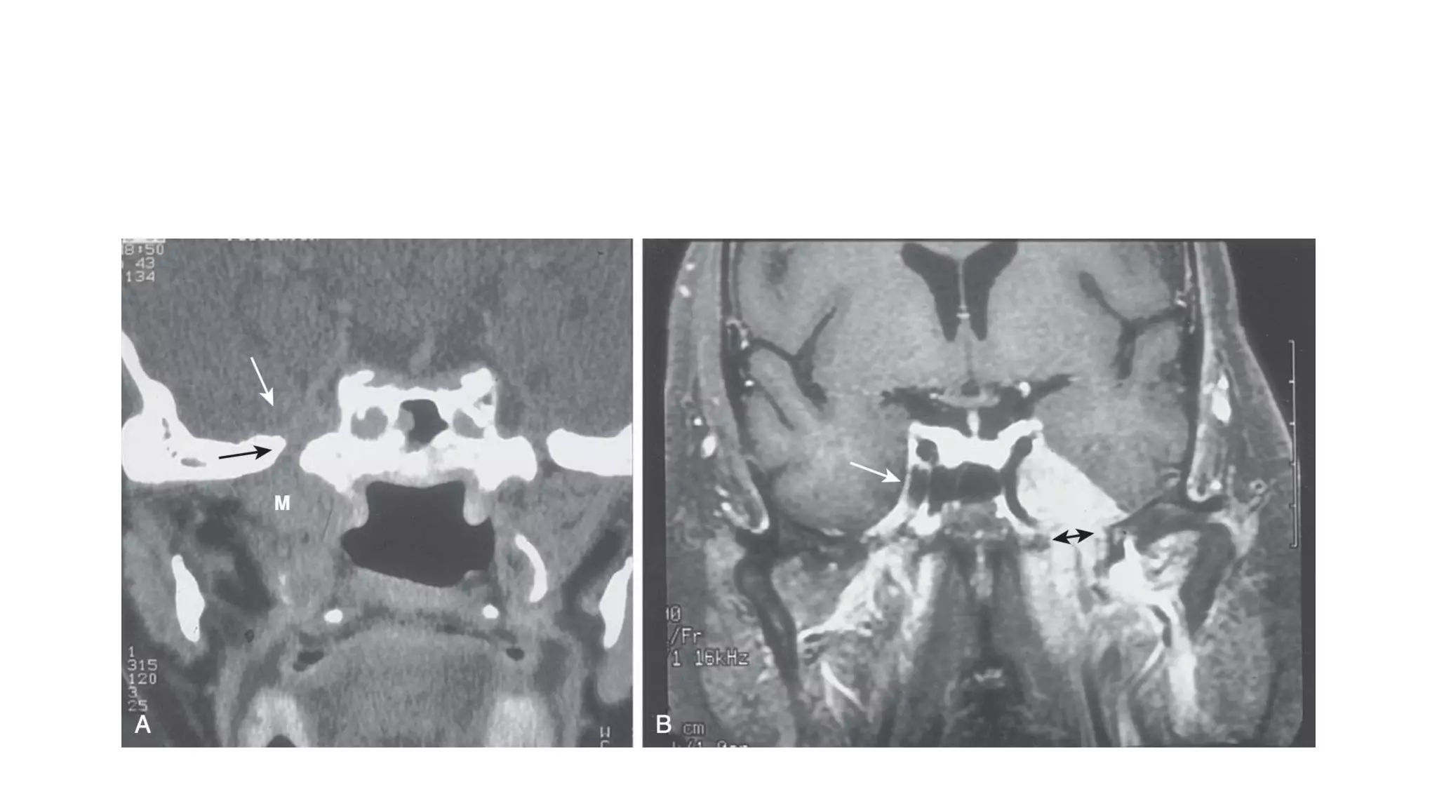 Ca Nasopharynx contouring.pptx