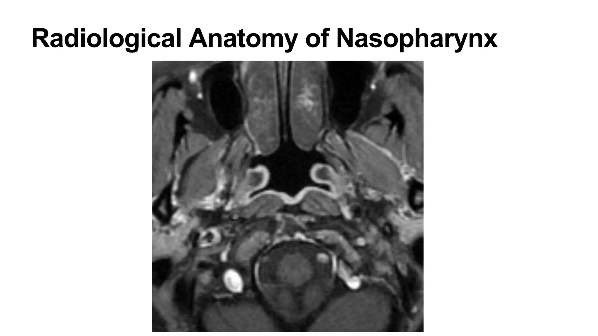 Ca Nasopharynx contouring.pptx