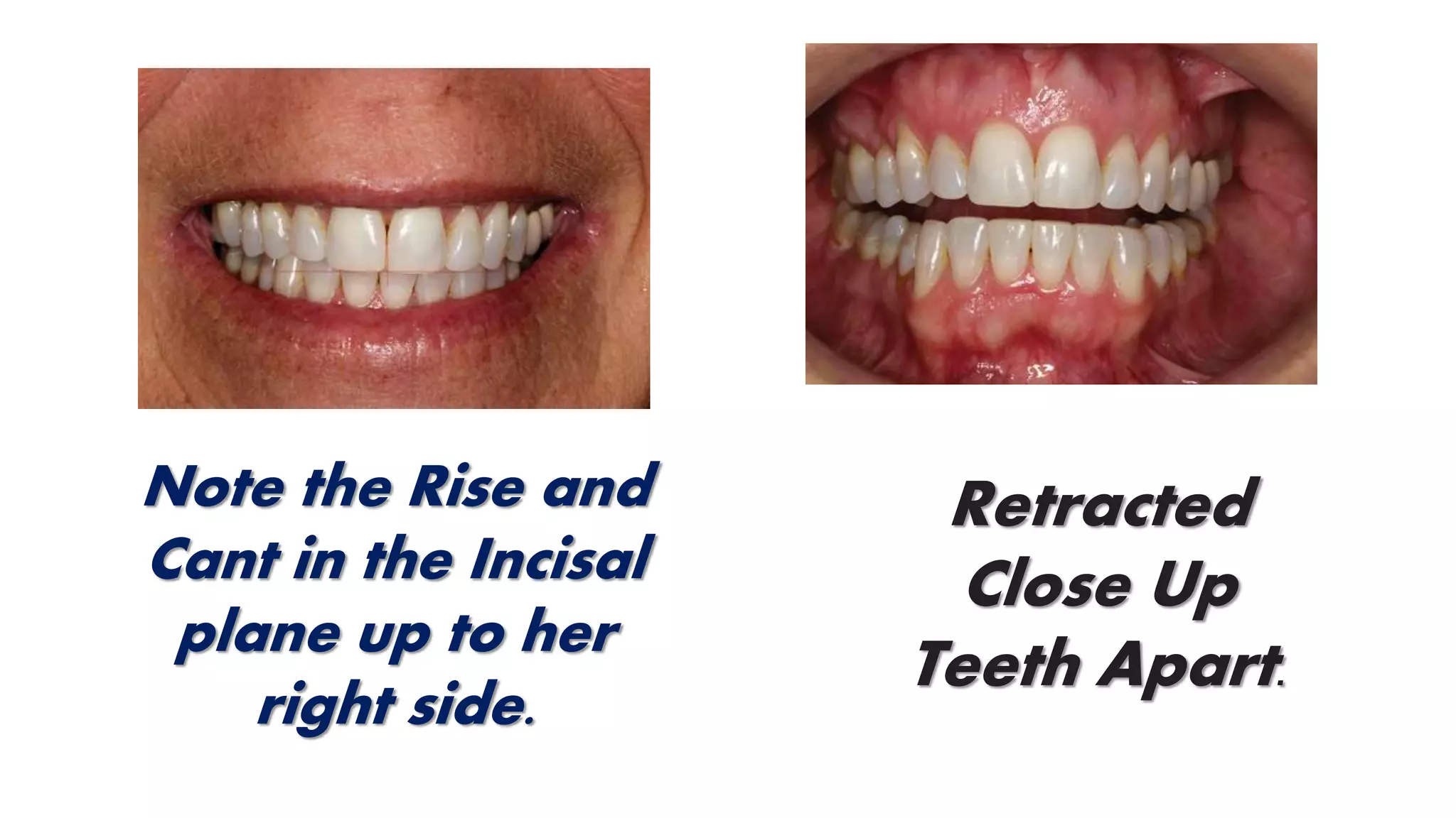 Canted occlusal plane ; etiology and evaluation part 1 | PPTX