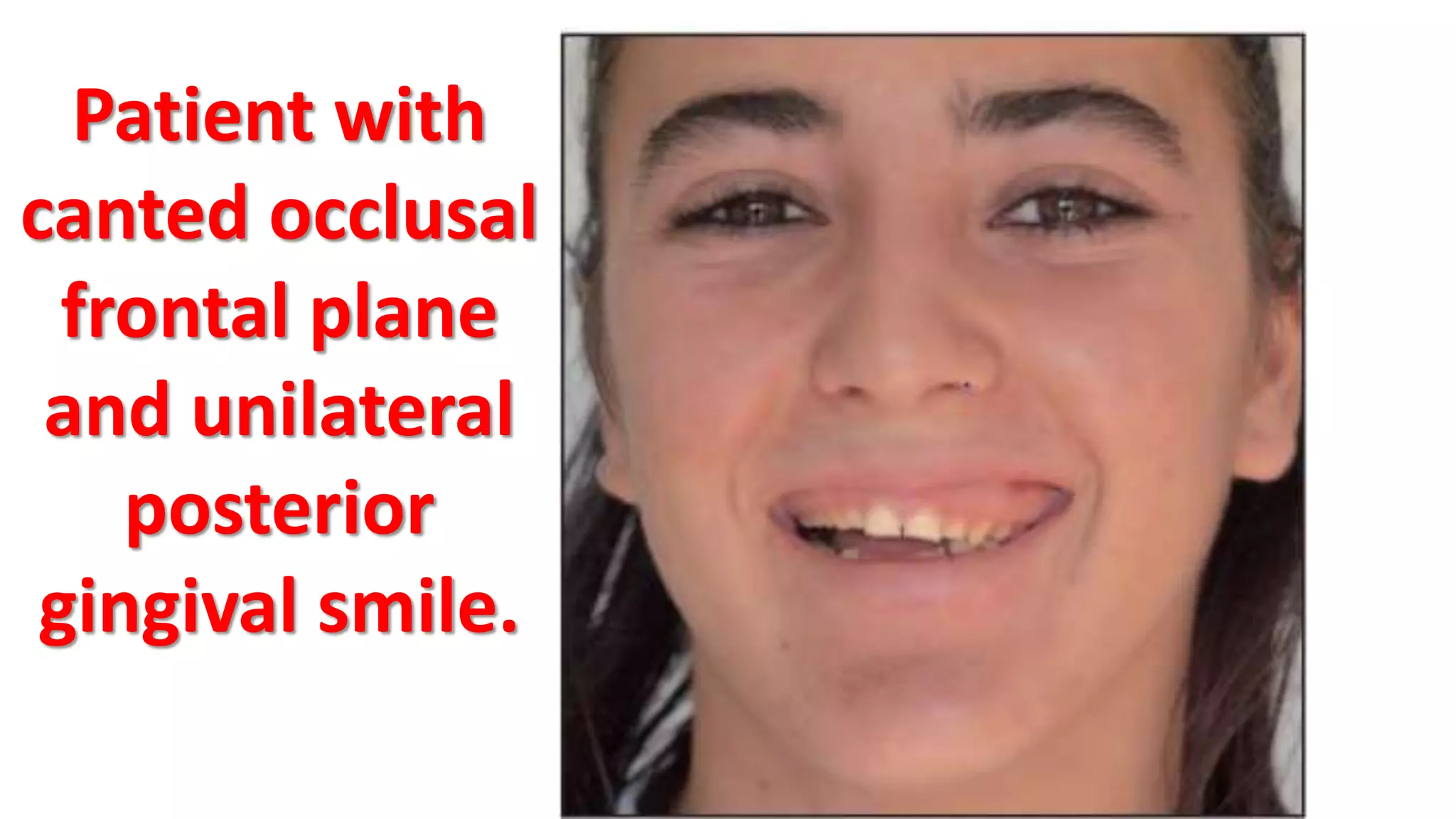 Canted occlusal plane ; etiology and evaluation part 1 | PPTX