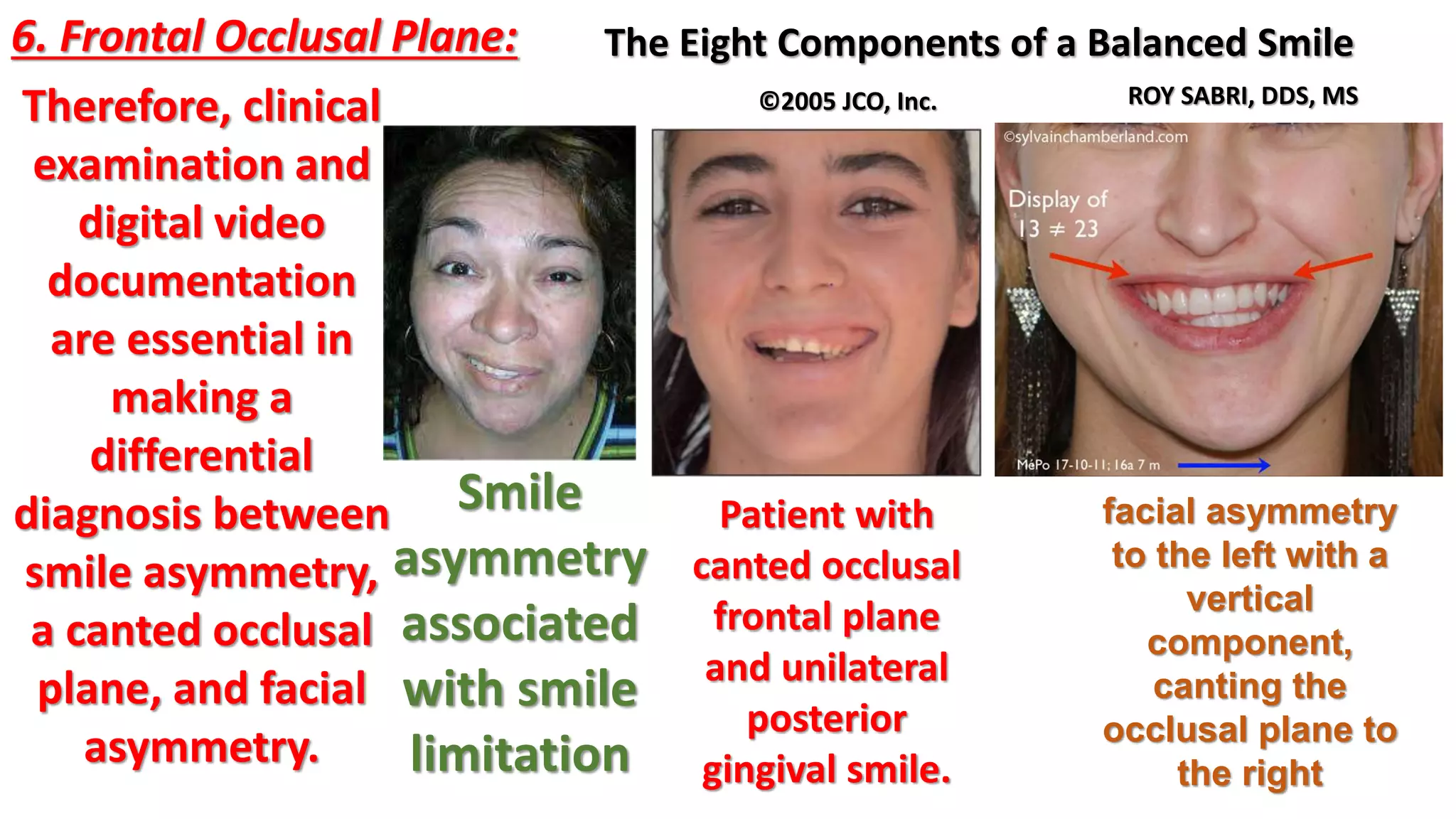 Canted occlusal plane ; etiology and evaluation part 1 | PPTX