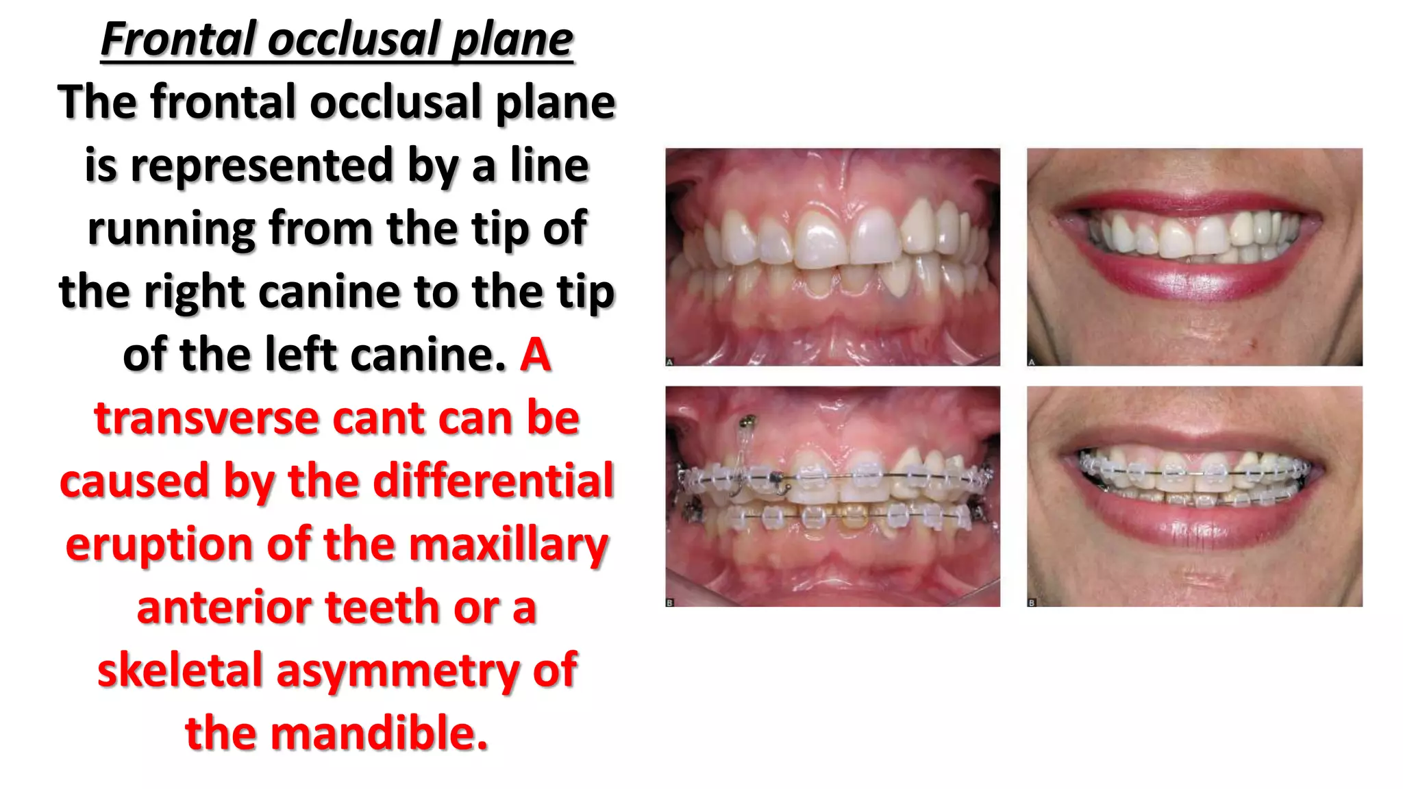 Canted occlusal plane ; etiology and evaluation part 1 | PPTX