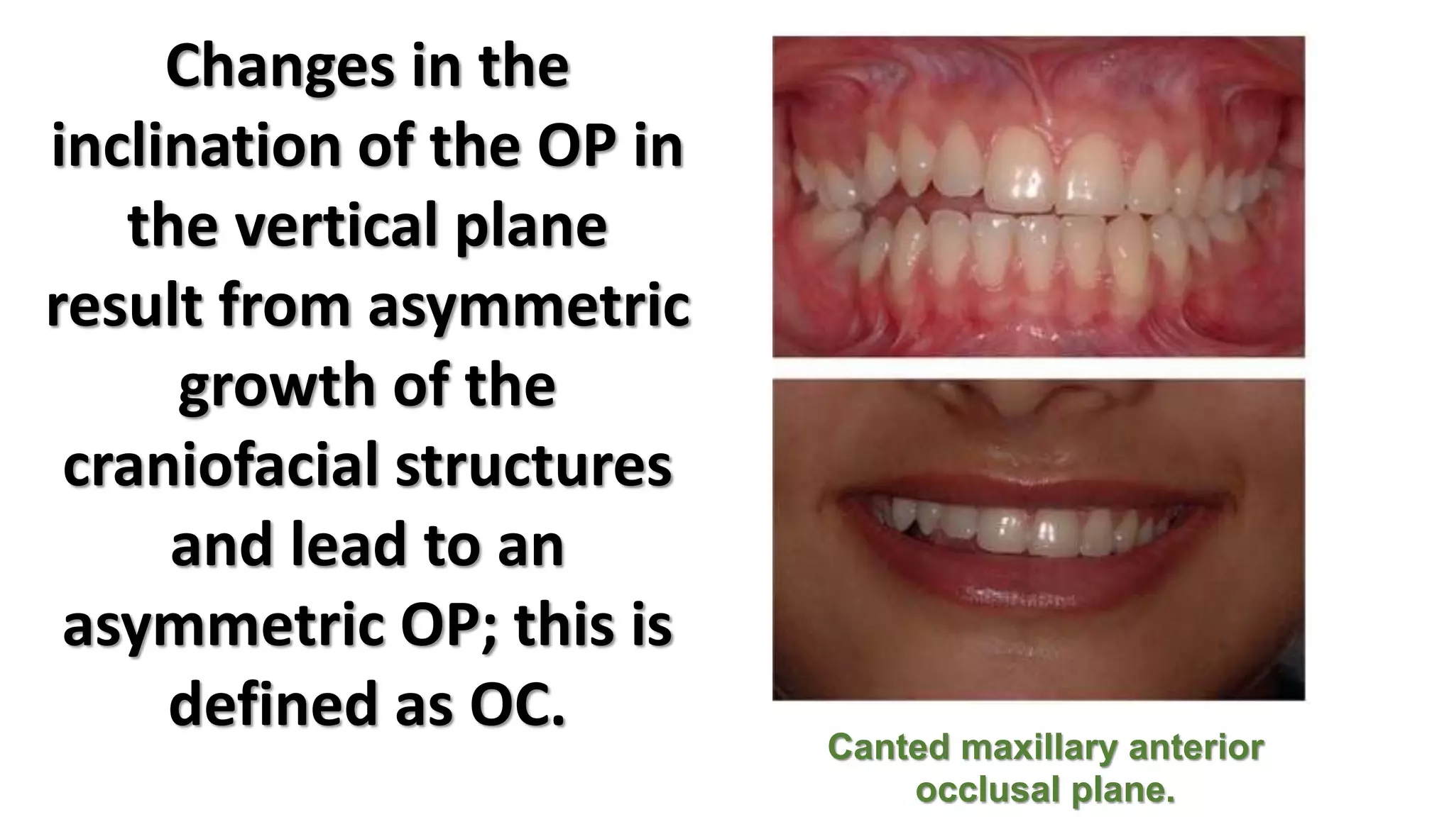 Canted occlusal plane ; etiology and evaluation part 1 | PPTX | Dental ...