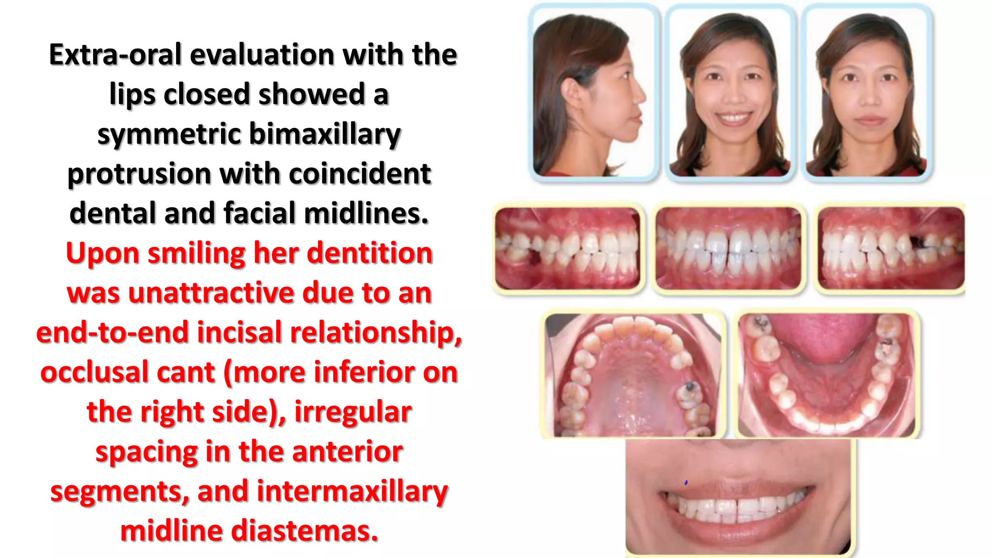 Canted occlusal plane ; etiology and evaluation part 1 | PPTX