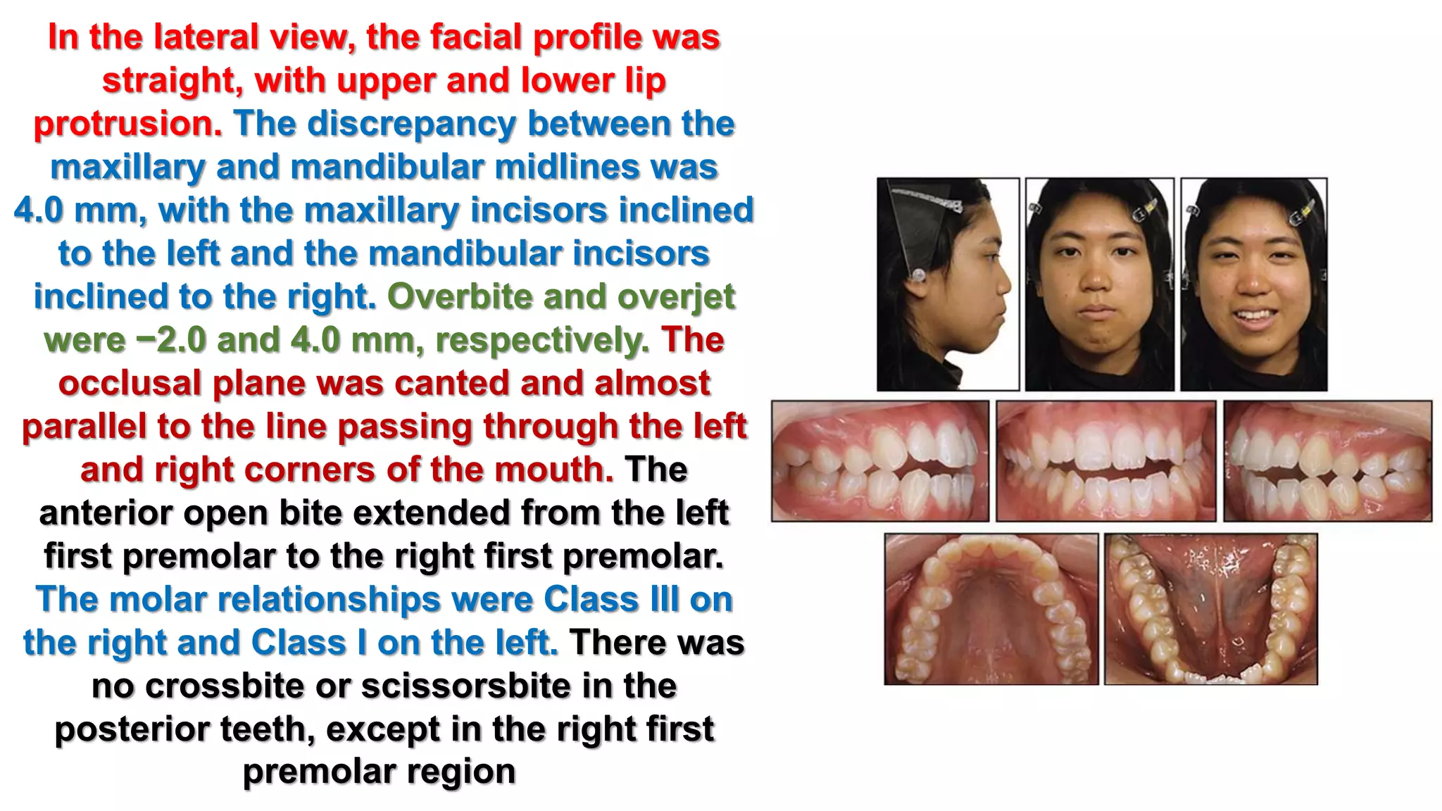 Canted occlusal plane ; etiology and evaluation part 1 | PPTX