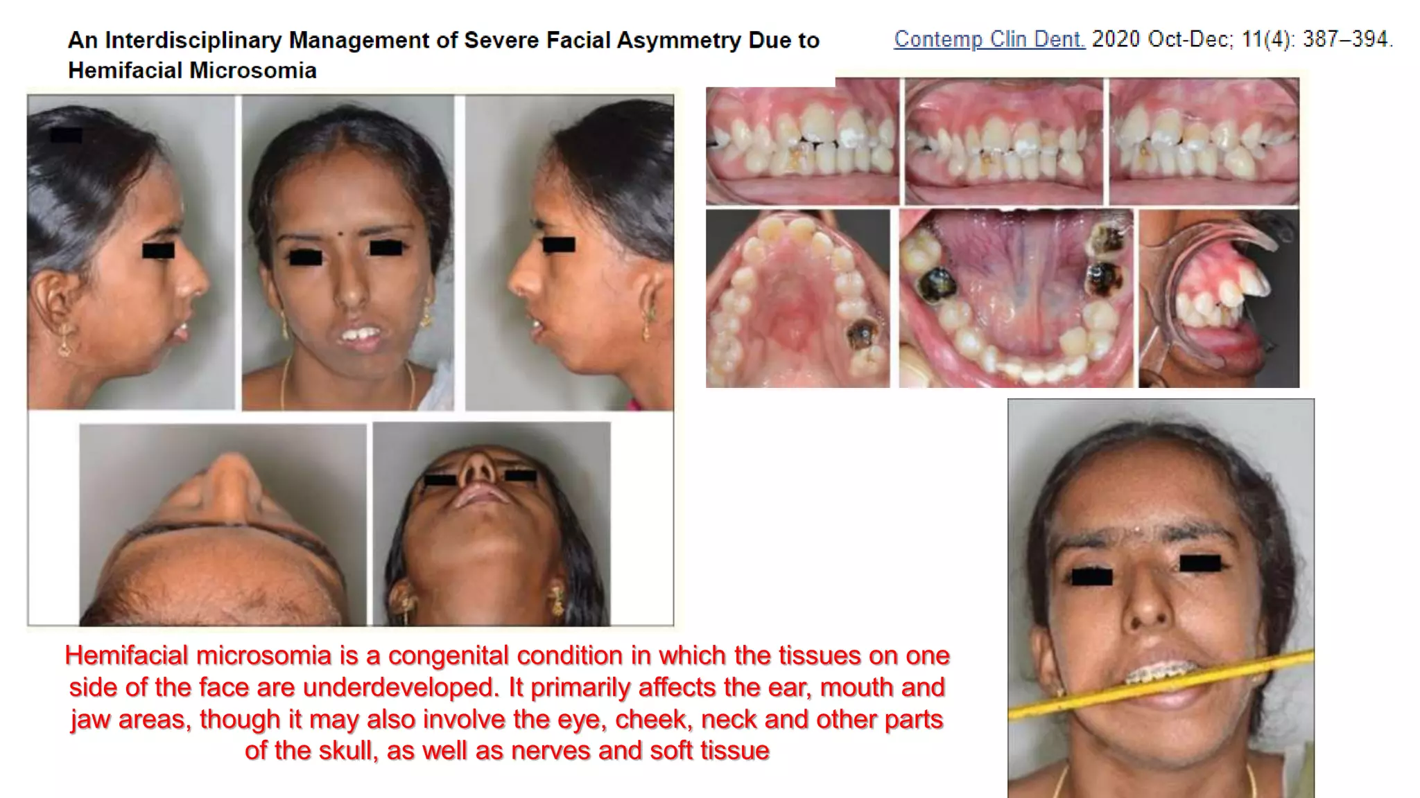 Canted occlusal plane ; etiology and evaluation part 1 | PPTX