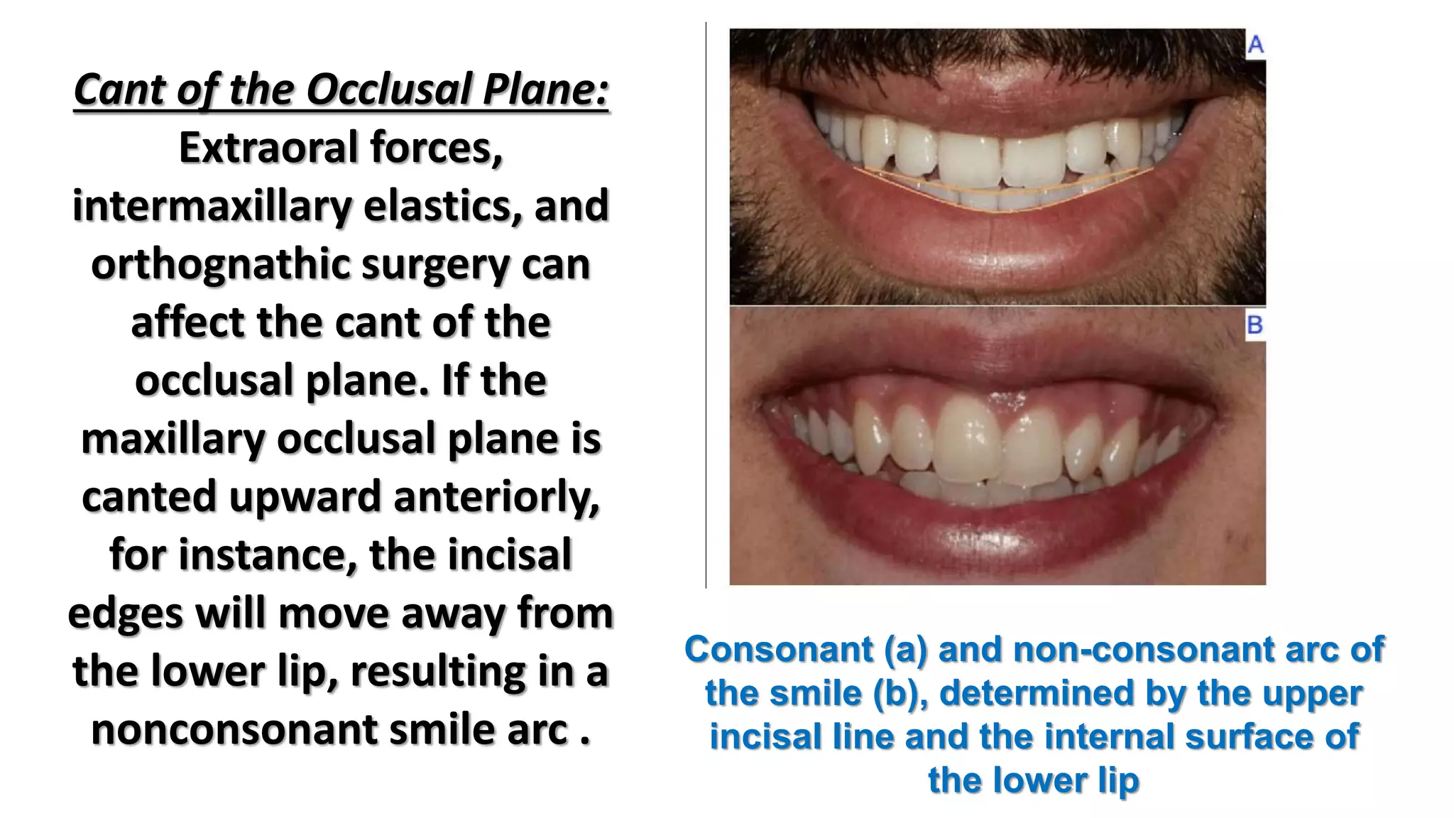 Canted occlusal plane ; etiology and evaluation part 1 | PPTX | Dental ...