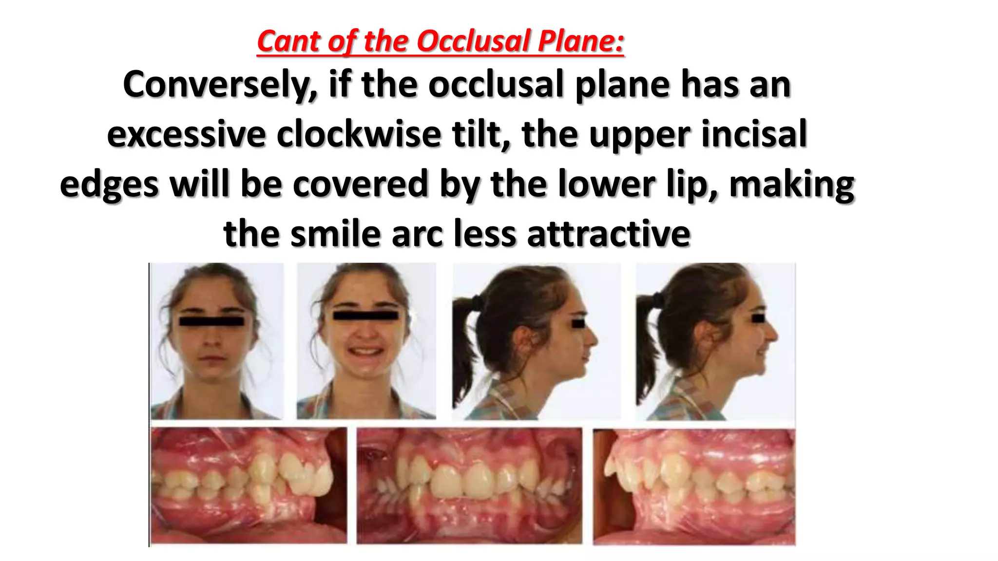Canted occlusal plane ; etiology and evaluation part 1 | PPTX
