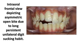 Canted occlusal plane ; etiology and evaluation part 1 | PPTX