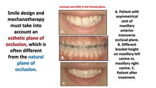 Canted occlusal plane ; etiology and evaluation part 1 | PPTX