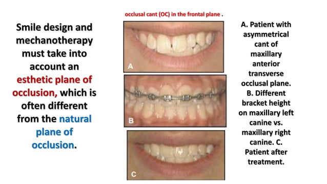 Canted occlusal plane ; etiology and evaluation part 1 | PPTX | Dental ...