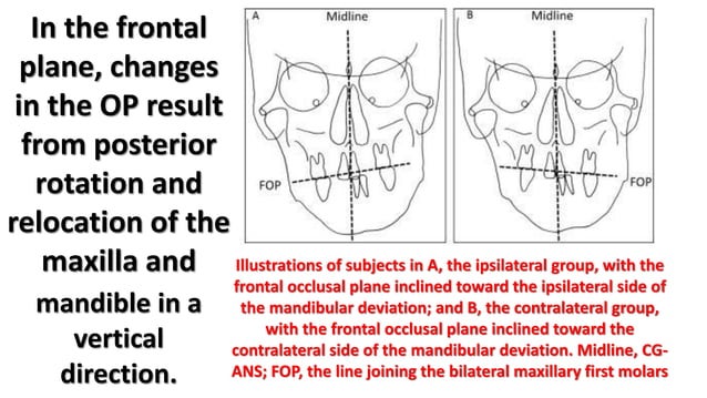 Canted occlusal plane ; etiology and evaluation part 1 | PPTX | Dental ...