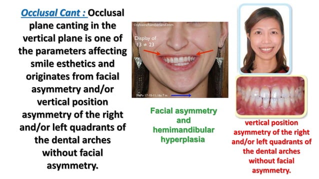 Canted occlusal plane ; etiology and evaluation part 1 | PPTX | Dental ...