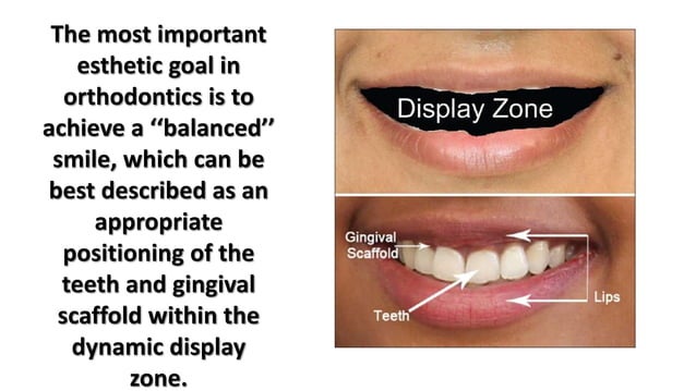 Canted occlusal plane ; etiology and evaluation part 1 | PPTX | Dental ...