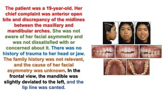 Canted occlusal plane ; etiology and evaluation part 1 | PPTX