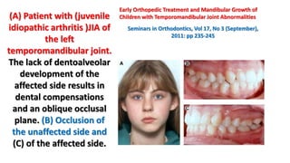 Canted occlusal plane ; etiology and evaluation part 1 | PPTX