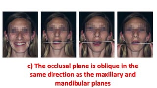 Canted occlusal plane ; etiology and evaluation part 1 | PPTX