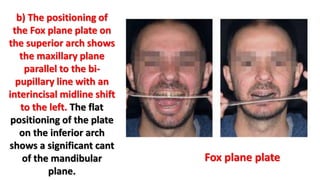 Canted occlusal plane ; etiology and evaluation part 1 | PPTX