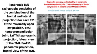 Canted occlusal plane ; etiology and evaluation part 1 | PPTX