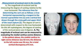 Canted occlusal plane ; etiology and evaluation part 1 | PPTX
