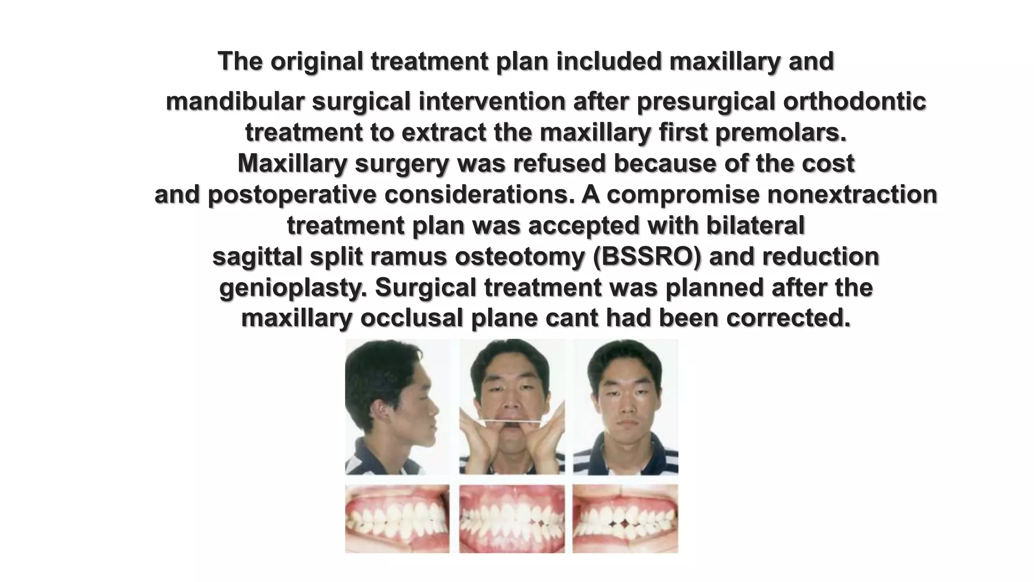 ORTHODONTIC CORRECTION OF OCCLUSAL PLANE CANTING | PPTX
