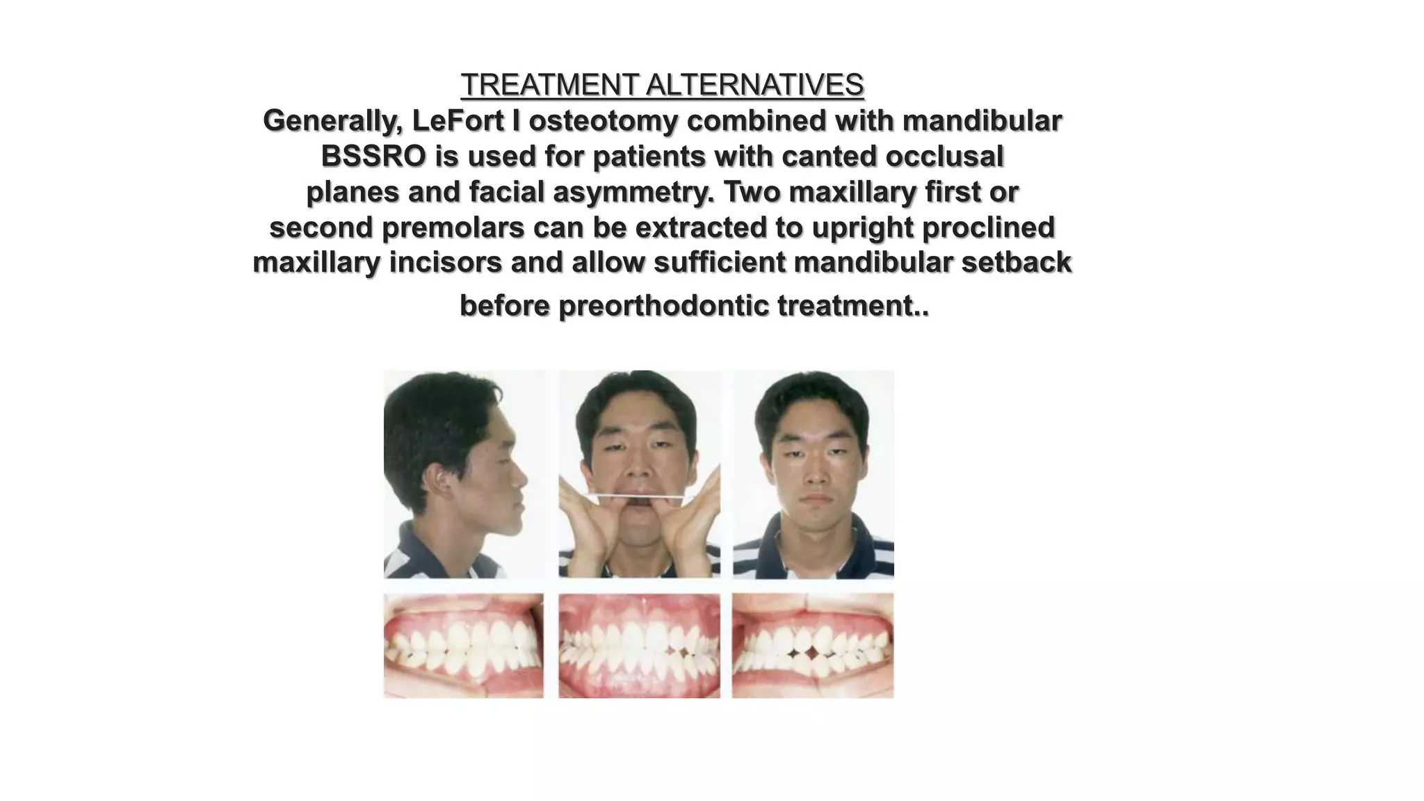 ORTHODONTIC CORRECTION OF OCCLUSAL PLANE CANTING | PPTX
