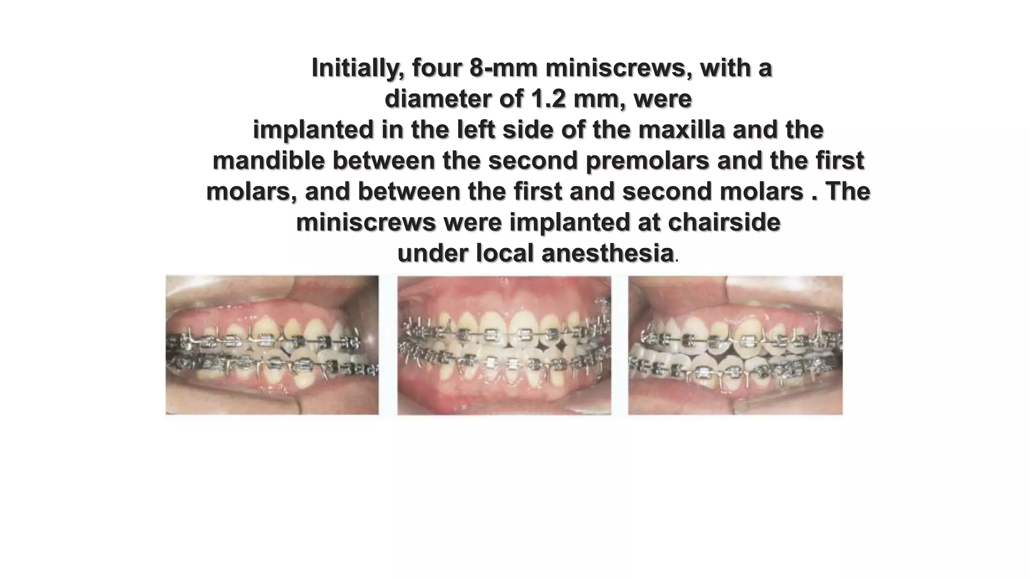ORTHODONTIC CORRECTION OF OCCLUSAL PLANE CANTING | PPTX