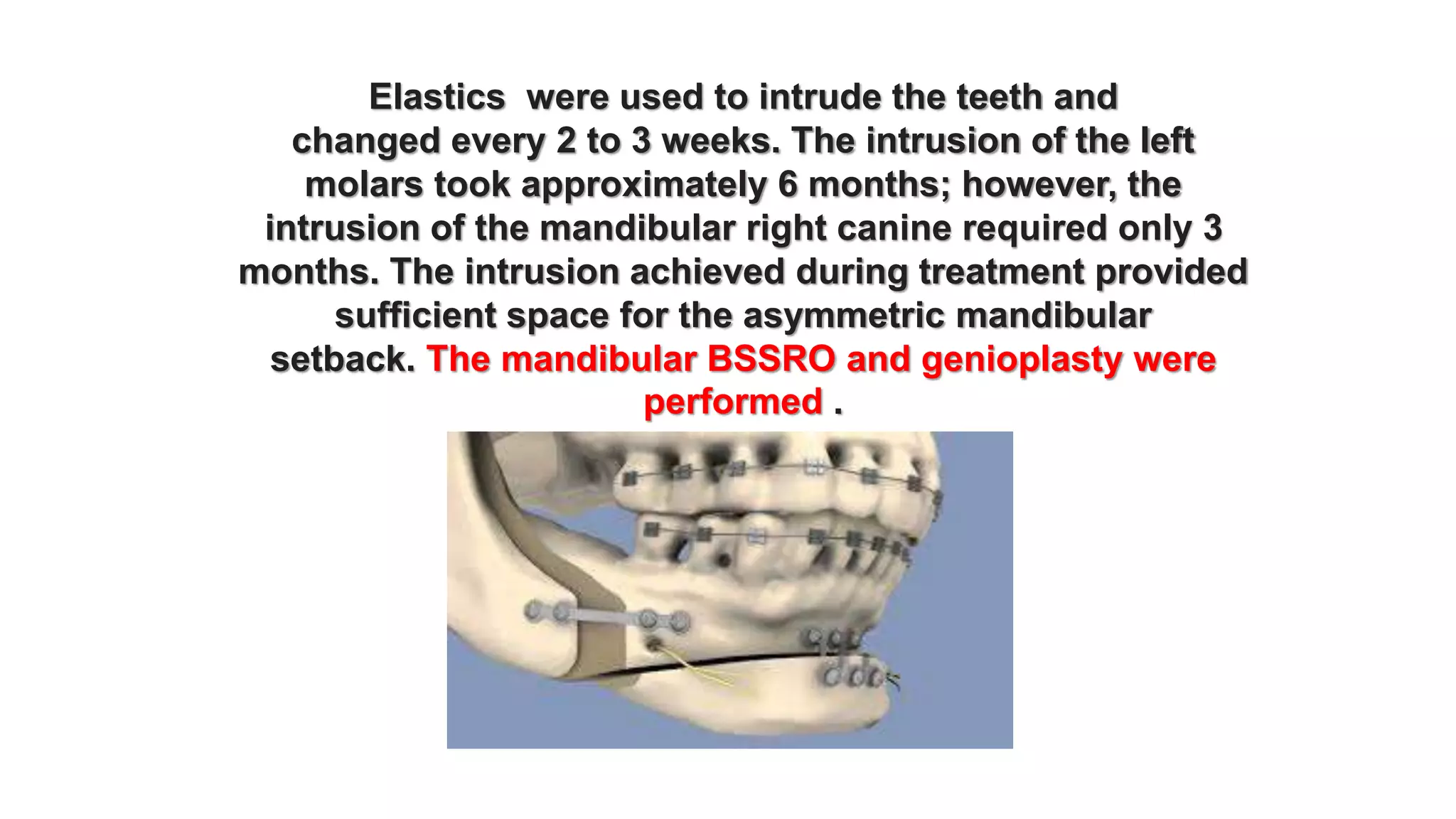 ORTHODONTIC CORRECTION OF OCCLUSAL PLANE CANTING | PPTX