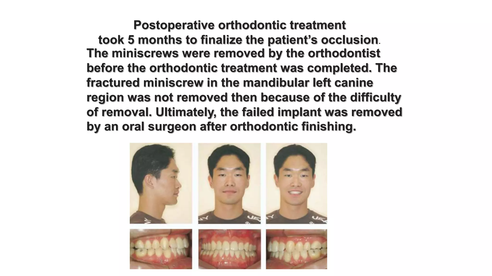 ORTHODONTIC CORRECTION OF OCCLUSAL PLANE CANTING | PPTX