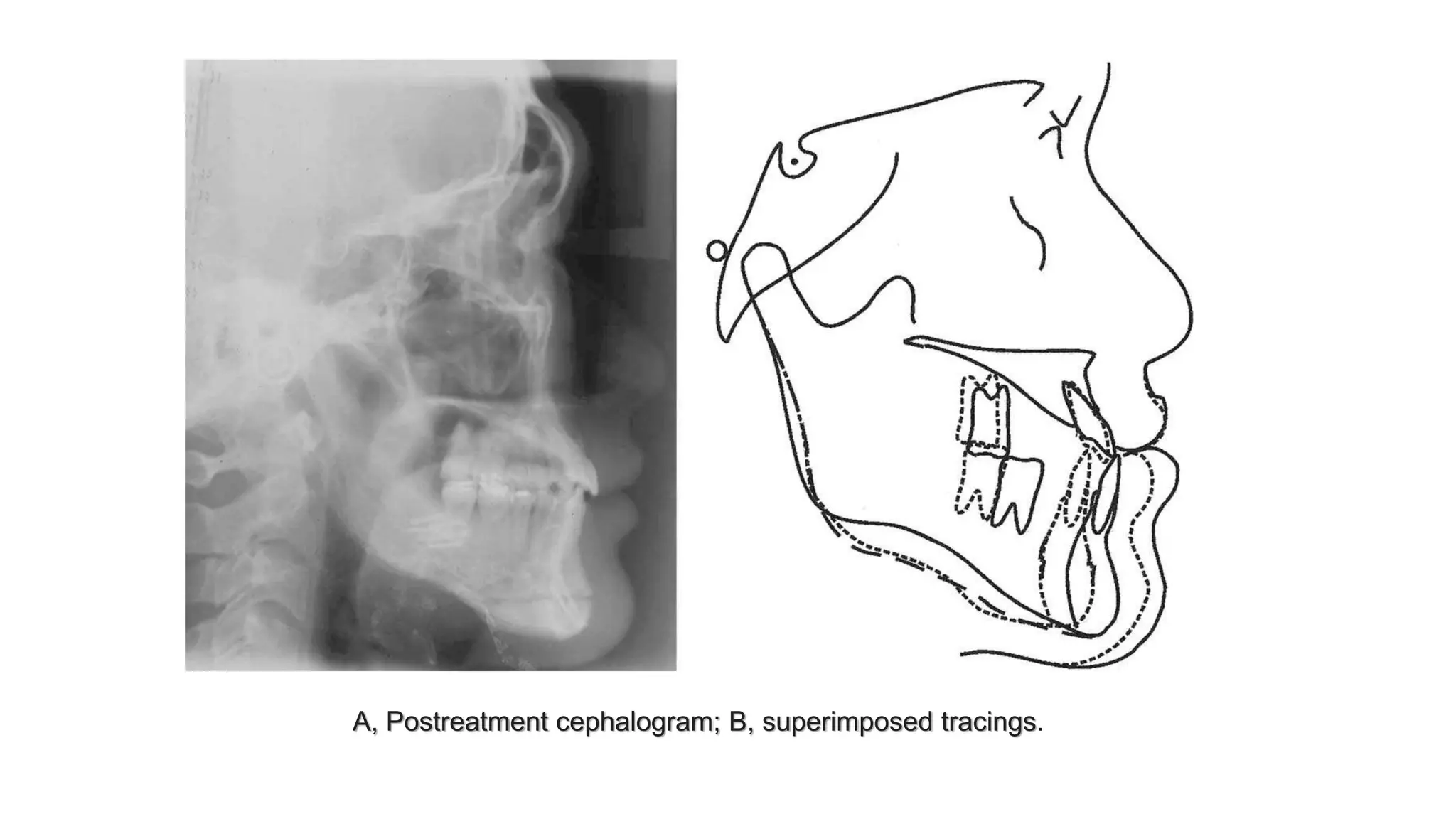 ORTHODONTIC CORRECTION OF OCCLUSAL PLANE CANTING | PPTX