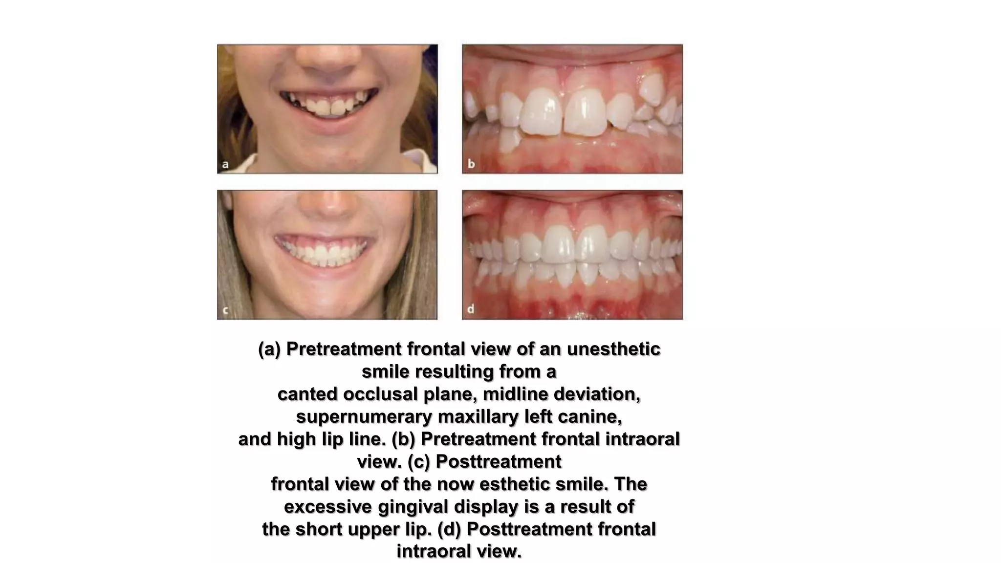ORTHODONTIC CORRECTION OF OCCLUSAL PLANE CANTING | PPTX