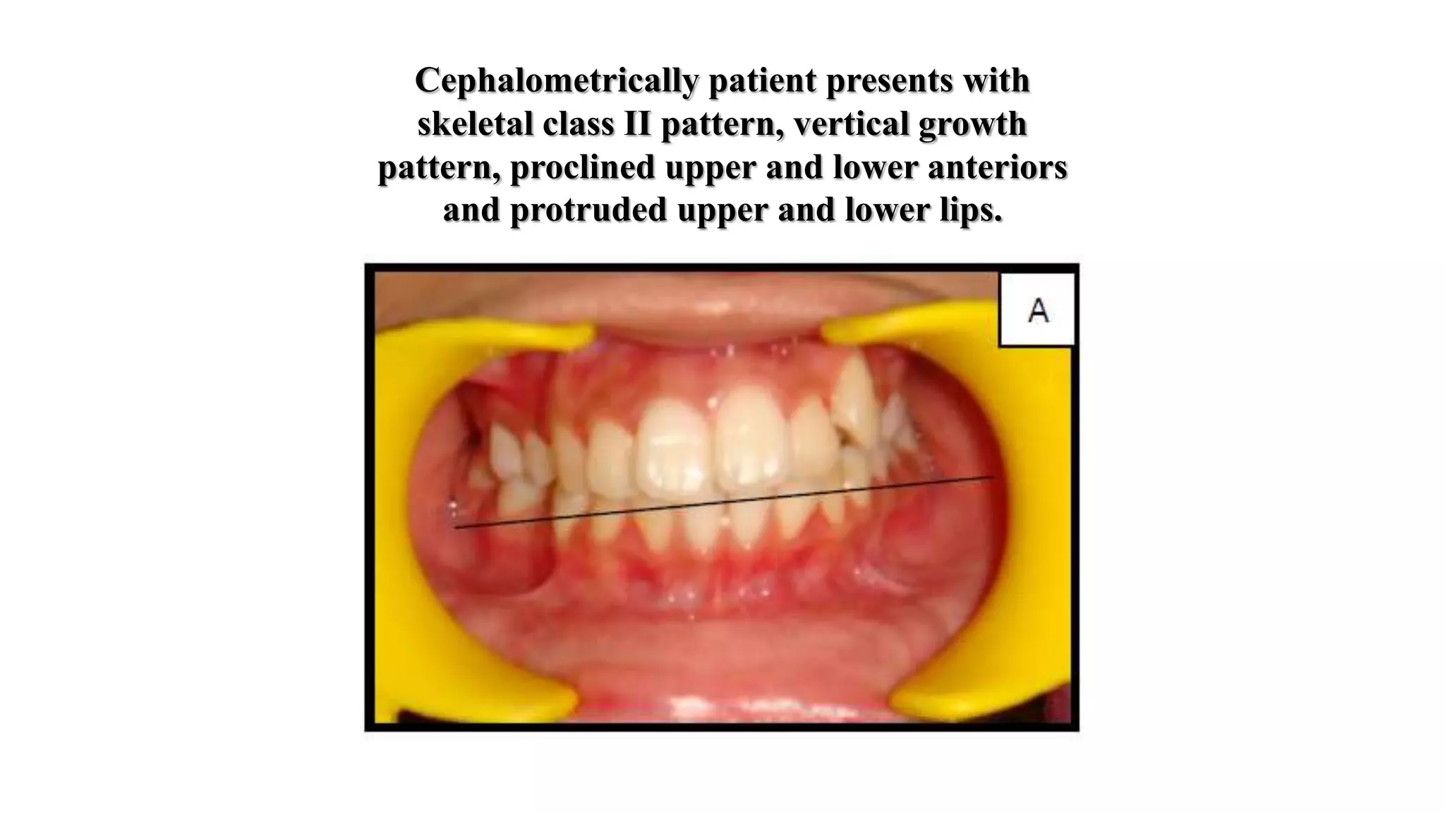 ORTHODONTIC CORRECTION OF OCCLUSAL PLANE CANTING | PPTX