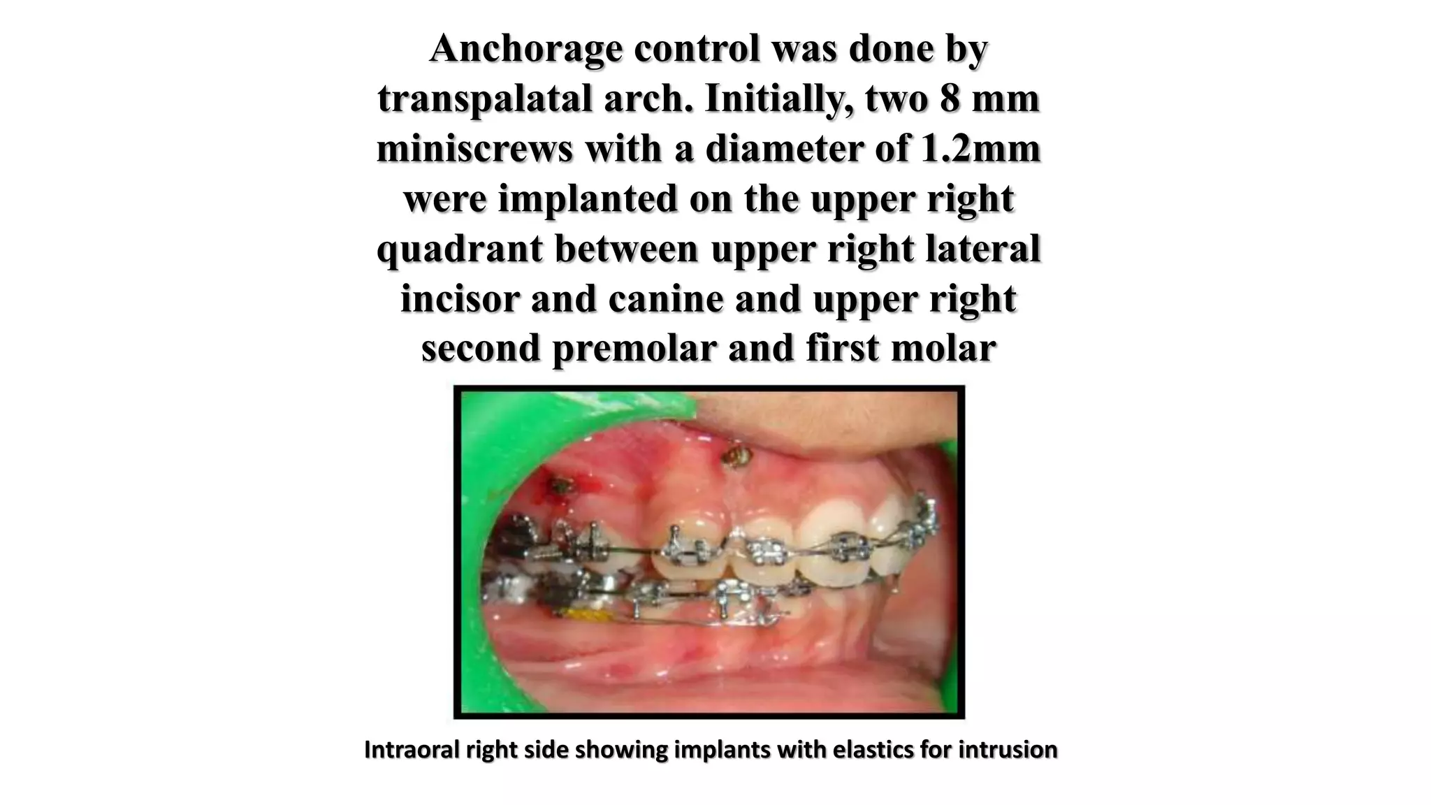 ORTHODONTIC CORRECTION OF OCCLUSAL PLANE CANTING | PPTX