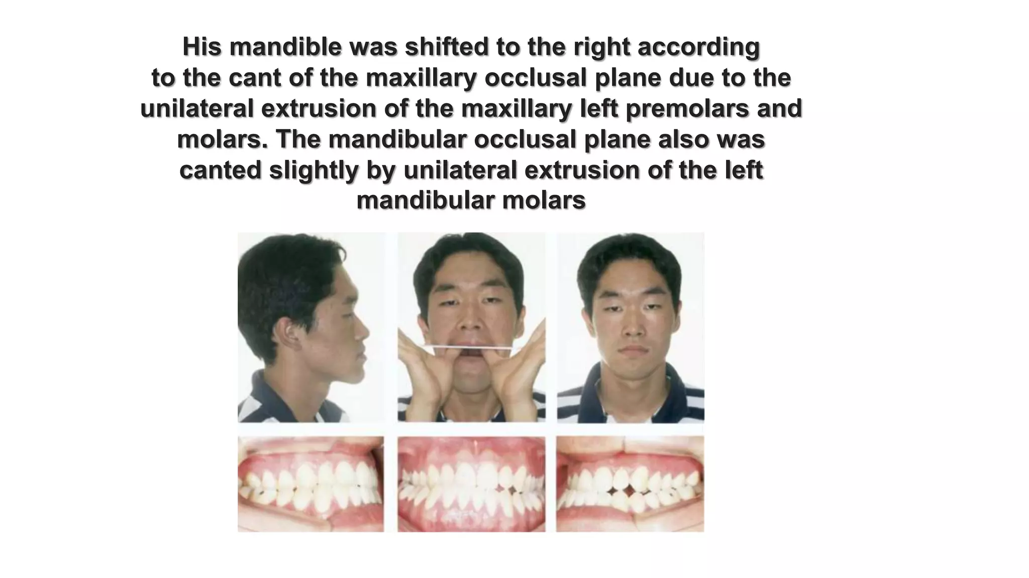 ORTHODONTIC CORRECTION OF OCCLUSAL PLANE CANTING | PPTX