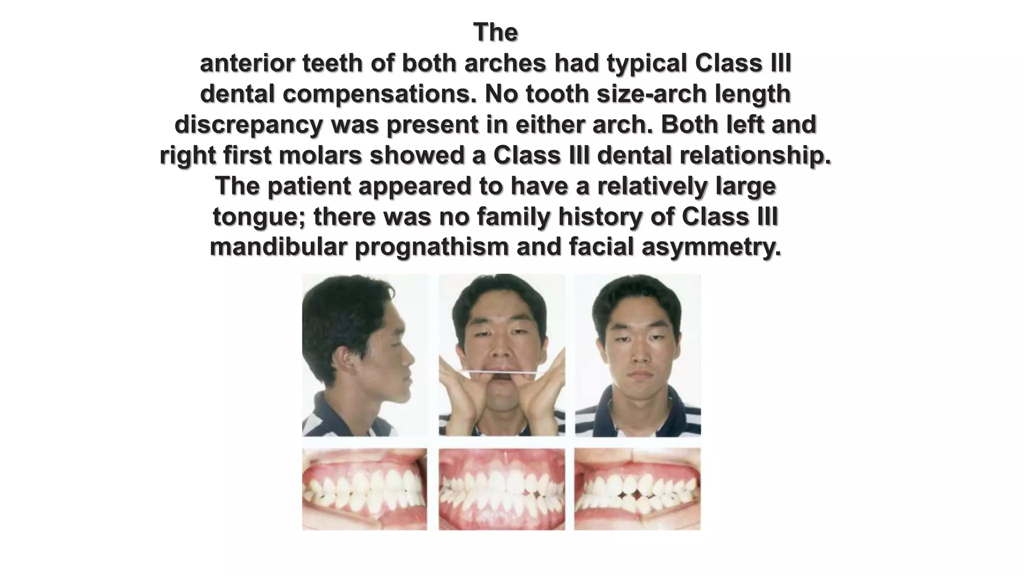 ORTHODONTIC CORRECTION OF OCCLUSAL PLANE CANTING | PPTX