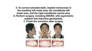 ORTHODONTIC CORRECTION OF OCCLUSAL PLANE CANTING | PPTX