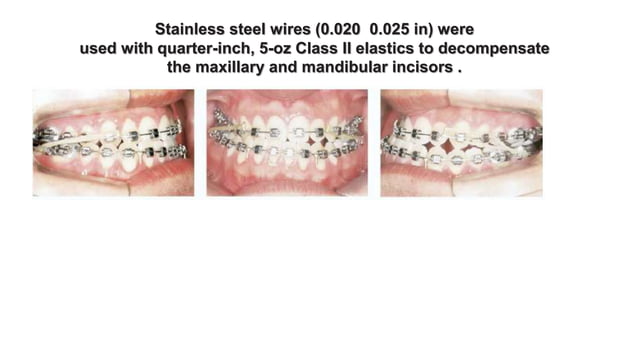 ORTHODONTIC CORRECTION OF OCCLUSAL PLANE CANTING | PPTX | Dental Health ...