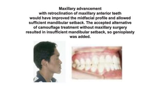 ORTHODONTIC CORRECTION OF OCCLUSAL PLANE CANTING | PPTX