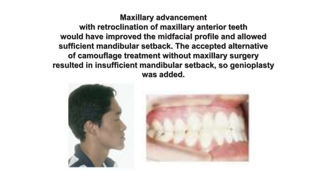 ORTHODONTIC CORRECTION OF OCCLUSAL PLANE CANTING | PPTX | Dental Health ...