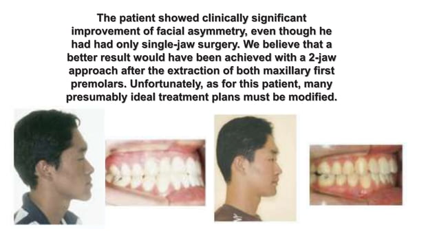 ORTHODONTIC CORRECTION OF OCCLUSAL PLANE CANTING | PPTX | Dental Health ...