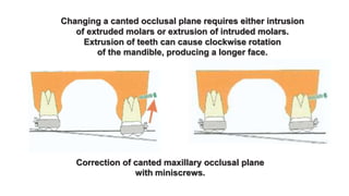 ORTHODONTIC CORRECTION OF OCCLUSAL PLANE CANTING | PPTX