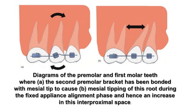 ORTHODONTIC CORRECTION OF OCCLUSAL PLANE CANTING | PPTX | Dental Health ...