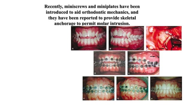 ORTHODONTIC CORRECTION OF OCCLUSAL PLANE CANTING | PPTX | Dental Health ...
